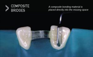 Dental Bridge Treatments at the Cambridge Dental Hub