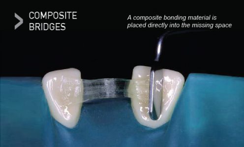 Dental Bridge Treatments at the Cambridge Dental Hub