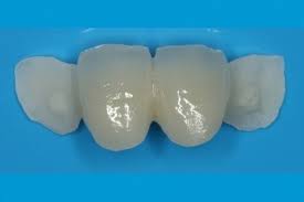 Dental Bridge Treatments at the Cambridge Dental Hub