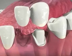 Dental Bridge Treatments at the Cambridge Dental Hub