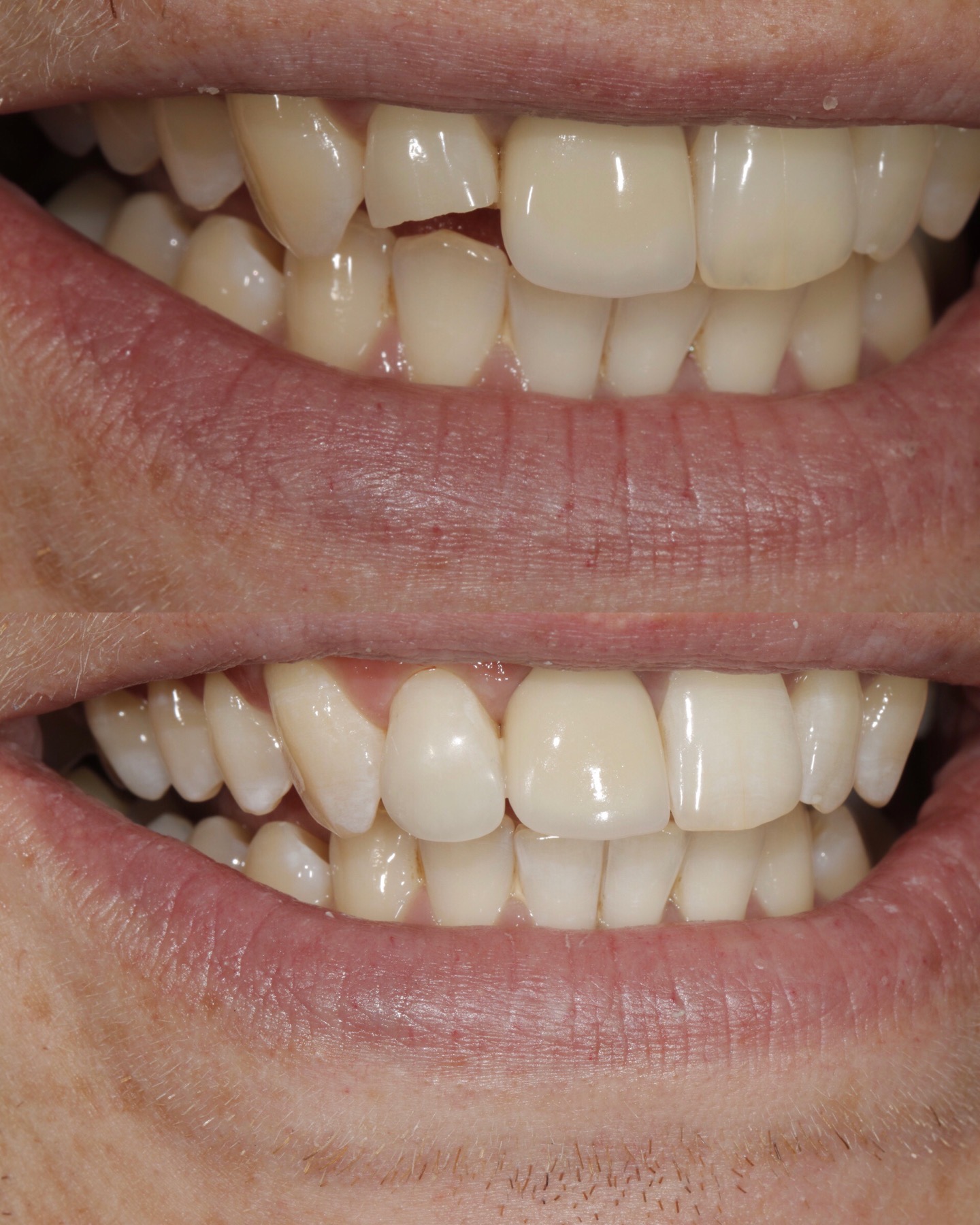 5* Stunning Composite Bonding Cambridge