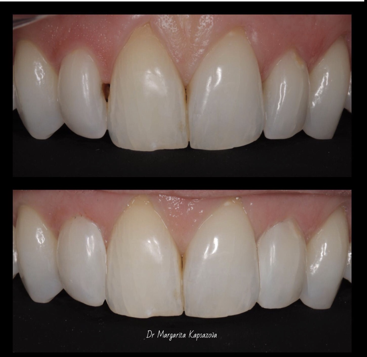 5* Stunning Composite Bonding Cambridge