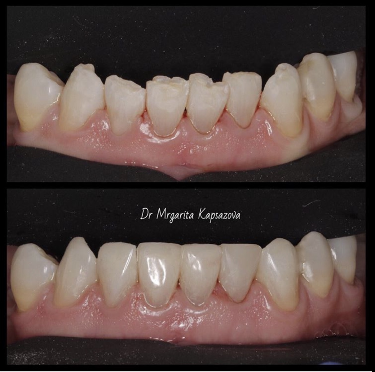 5* Stunning Composite Bonding Cambridge